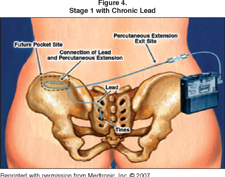 Figure 4 From Sacral Nerve Neuromodulation Interstim Part I Review