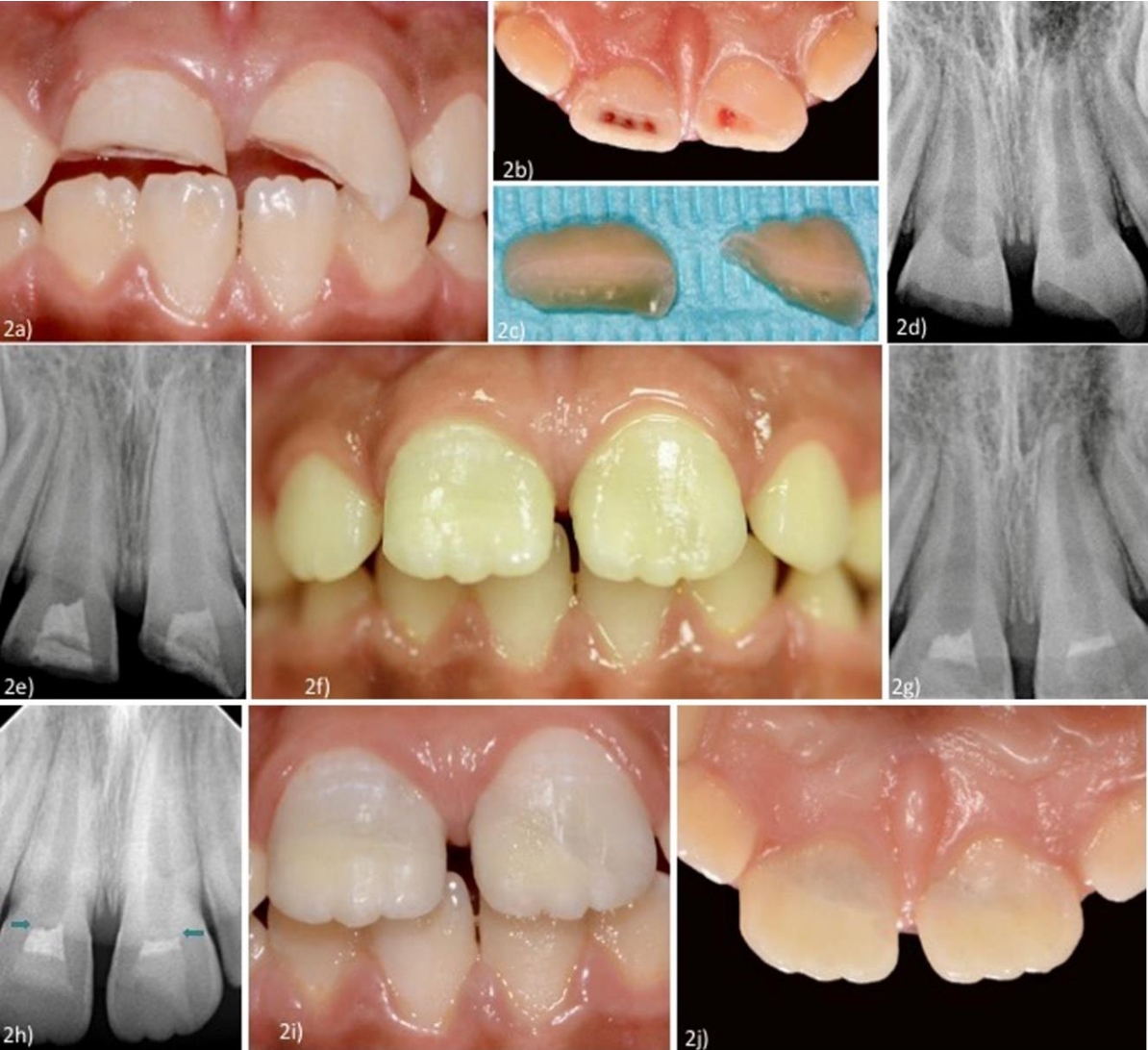 Partial Pulpotomy Of Immature Anterior Permanent Teeth With Complicated