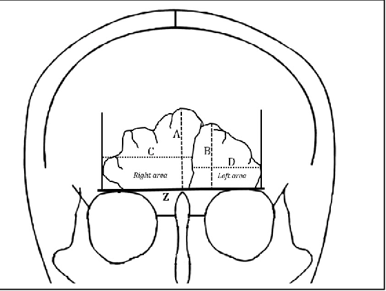 Figure 1 From The Relationship Between Frontal Sinus Morphology And