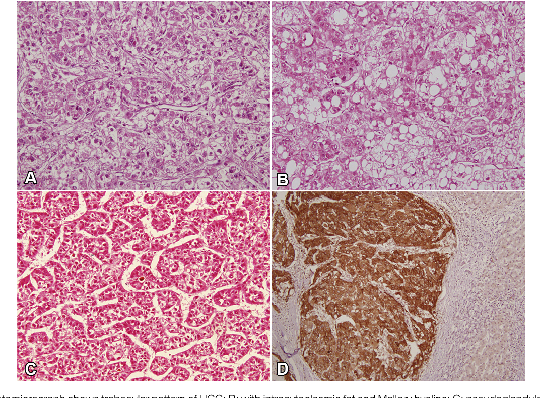 Figure 1 From Tissue Diagnosis Of Hepatocellular Carcinoma Semantic