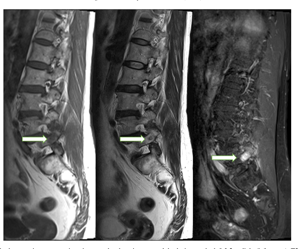 Osteoid Osteoma Spine Mri