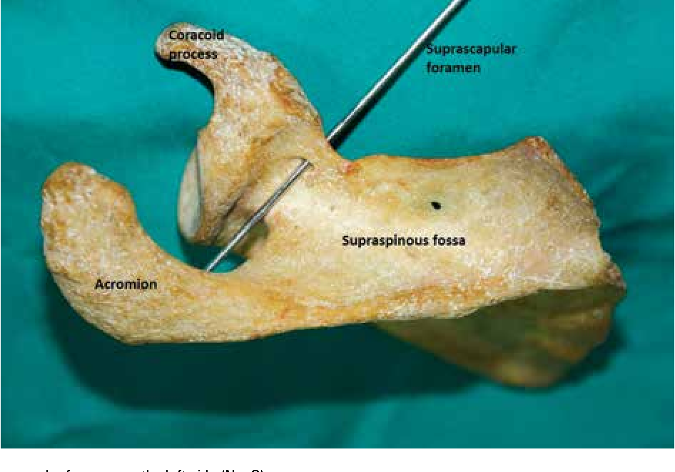 Figure 1 From Suprascapular Foramen A Rare Variation Caused By