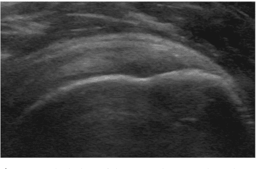 Figure 3 From Treatment Of Supraspinatus Tendinopathy With Ultrasound