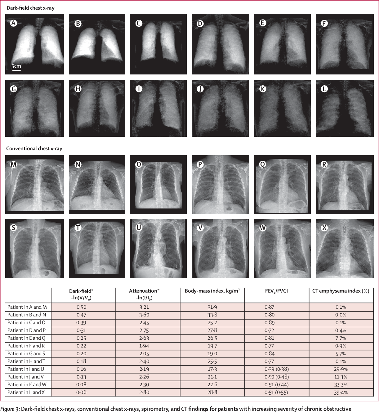 Figure 2 From X Ray Dark Field Chest Imaging For Detection And