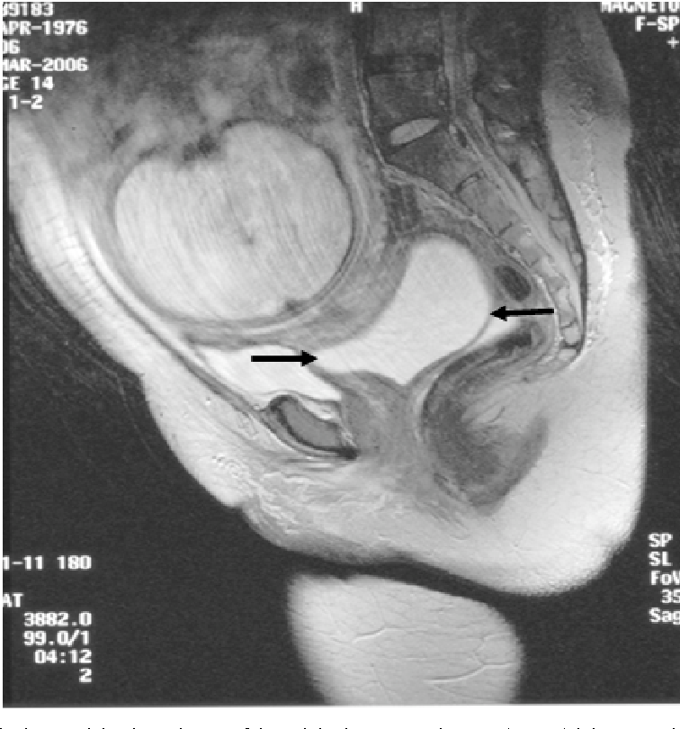 Figure 1 From Gartner Duct Cyst In Pregnancy Presenting As A Prolapsing