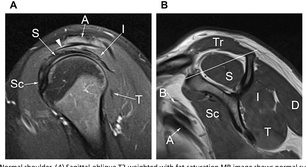 Sagittal Shoulder Mri Anatomy