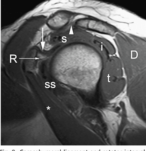 Figure 11 From Normal And Variant Anatomy Of The Shoulder On Mri