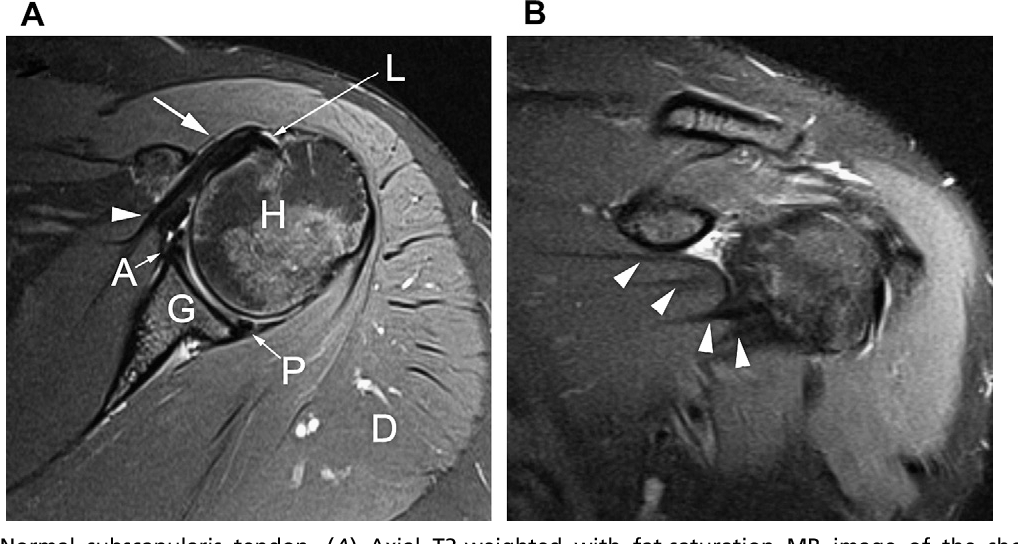 Figure 11 From Normal And Variant Anatomy Of The Shoulder On Mri