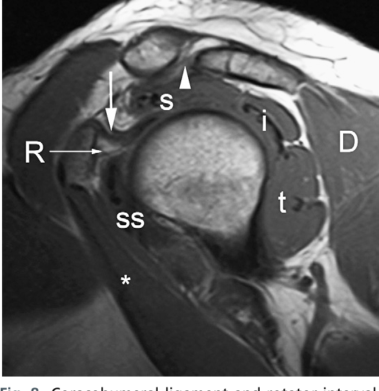 Figure 4 From Normal And Variant Anatomy Of The Shoulder On Mri