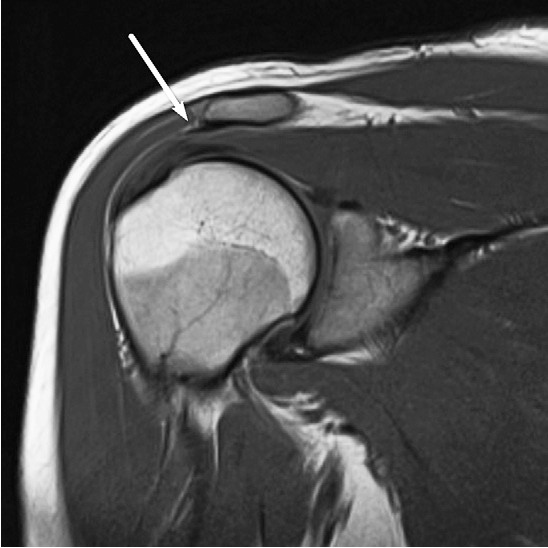 Figure 8 From Normal And Variant Anatomy Of The Shoulder On Mri