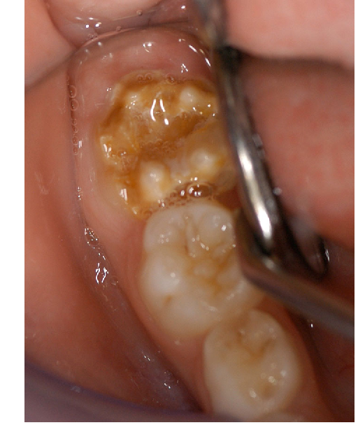 Figure 5 From The Würzburg Mih Concept The Mih Treatment Need Index