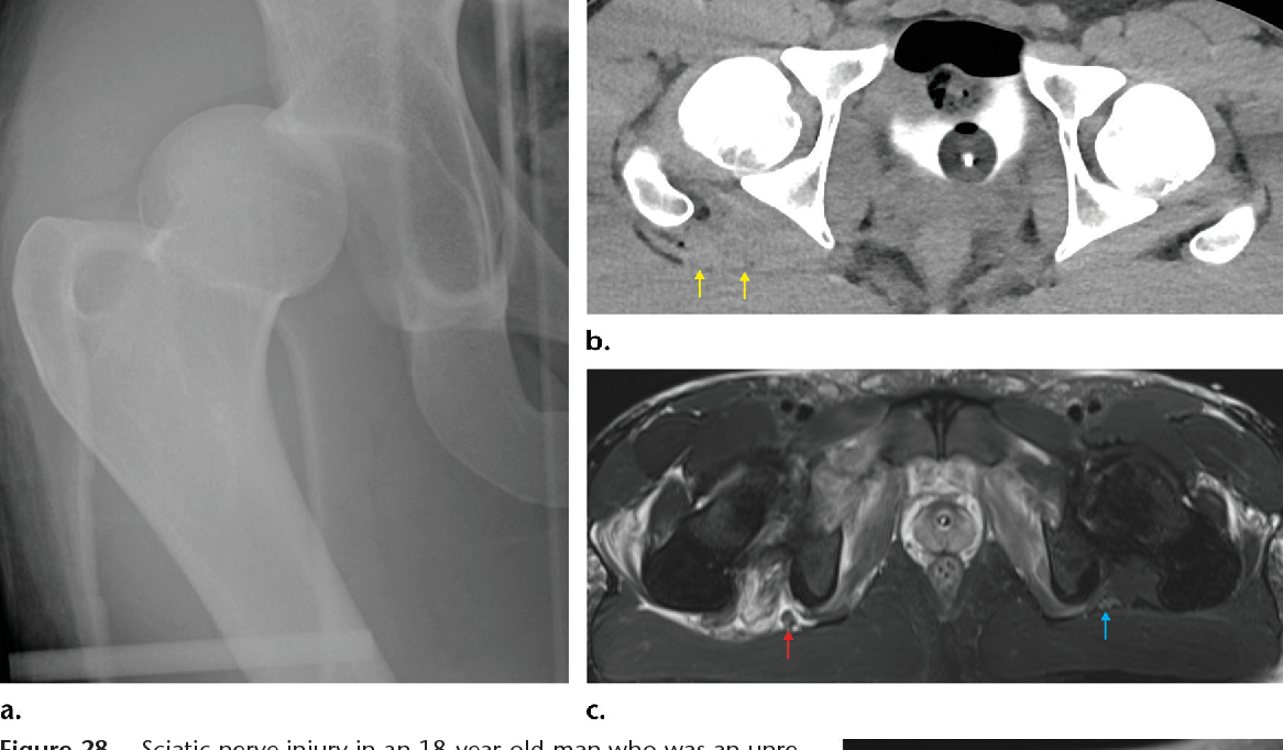 Traumatic Hip Dislocation What The Orthopedic Surgeon Wants To Know