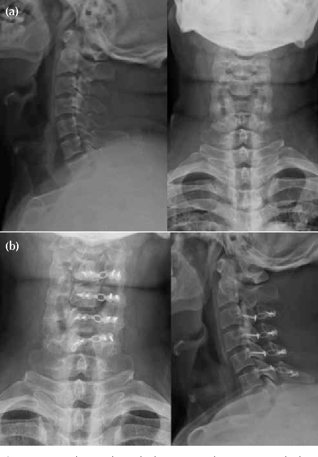 Figure 4 From Single Door Cervical Laminoplasty Using Titanium