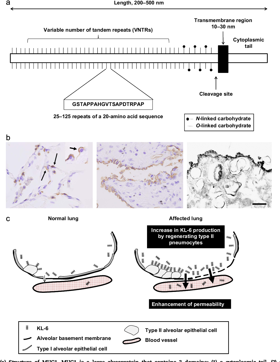 Pdf Utility Of Kl 6muc1 In The Clinical Management Of Interstitial