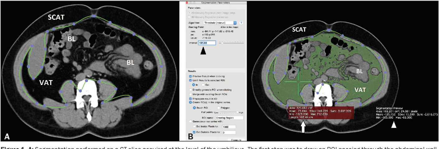 Figure 2 From Quantification Of Visceral Adipose Tissue By Computed