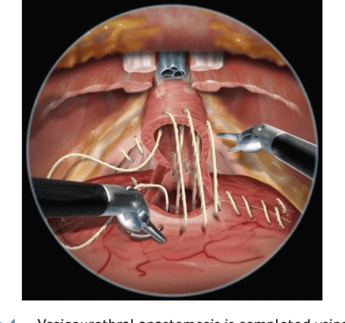 Figure 3 From Bidirectional Barbed Suture For Bladder Neck