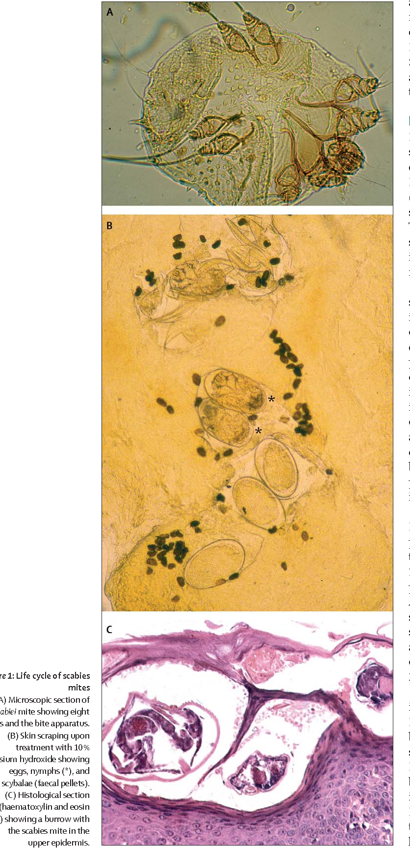 Figure 1 From Scabies A Ubiquitous Neglected Skin Disease Semantic