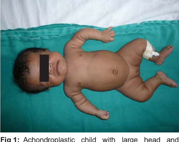 Pdf Achondroplasia Case Report And Review Of Literature Semantic