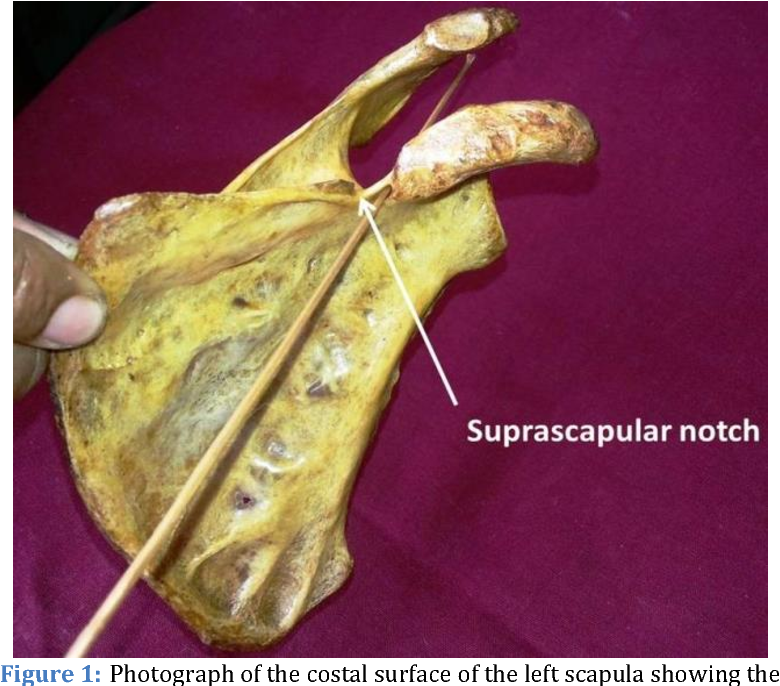Anatomy Of The Suprascapular Nerve Usabcd My Xxx Hot Girl