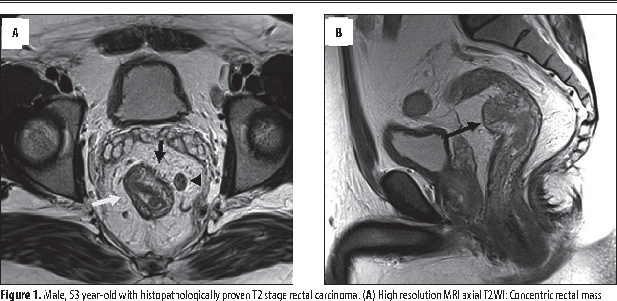 Rectal Cancer Staging Mri