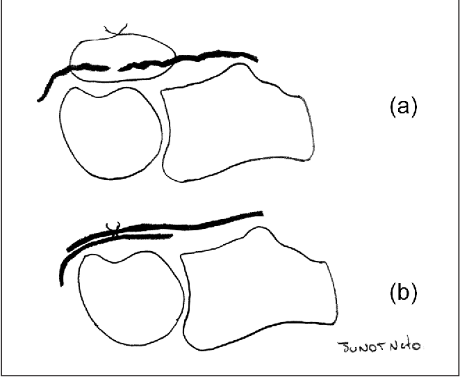 Triangular Fibrocartilage Tear Semantic Scholar