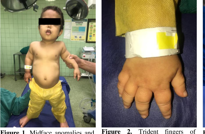 Figure 2 From Anesthetic Management Of A Patient With Achondroplasia