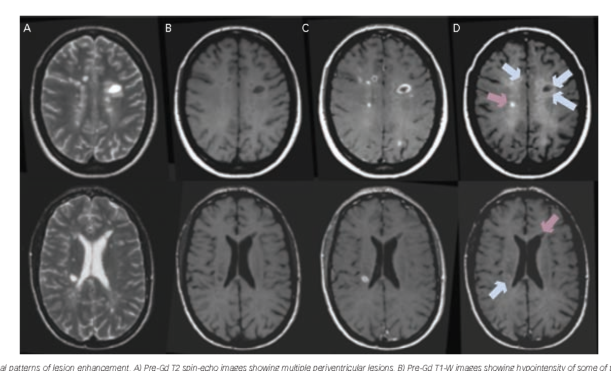 Pdf Multiple Sclerosis Role Of Contrast Enhanced Magnetic Resonance