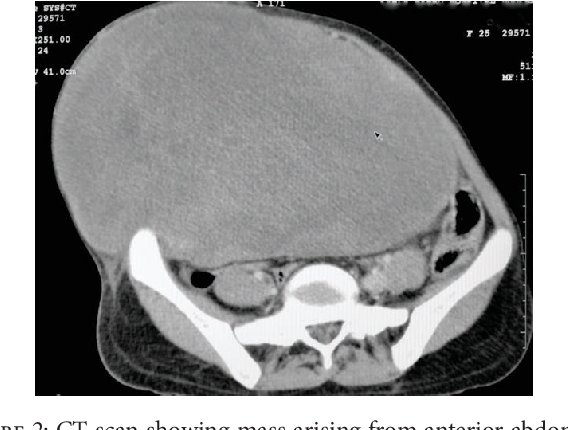 Figure 1 From Giant Desmoid Tumor Of The Anterior Abdominal Wall In A