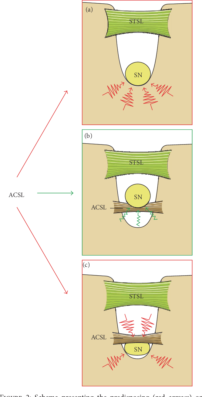 Figure 1 From Anterior Coracoscapular Ligament As A Factor Predisposing