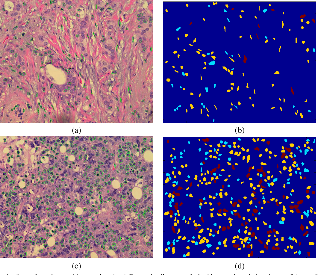 Figure 2 From Automatic Breast Cancer Grading Of Histopathological