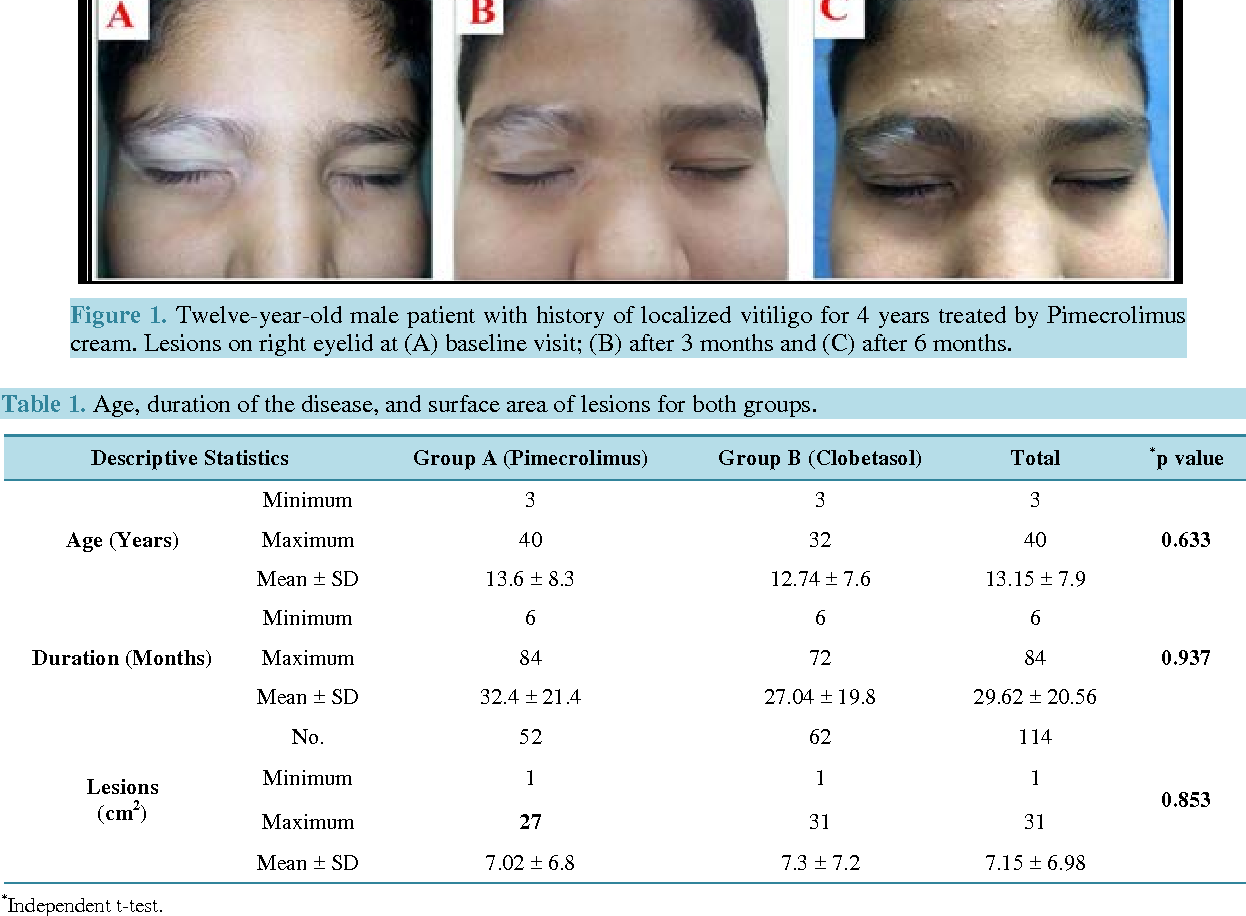 Table 2 From Treatment Of Localized Vitiligo With 1 Pimecrolimus Cream