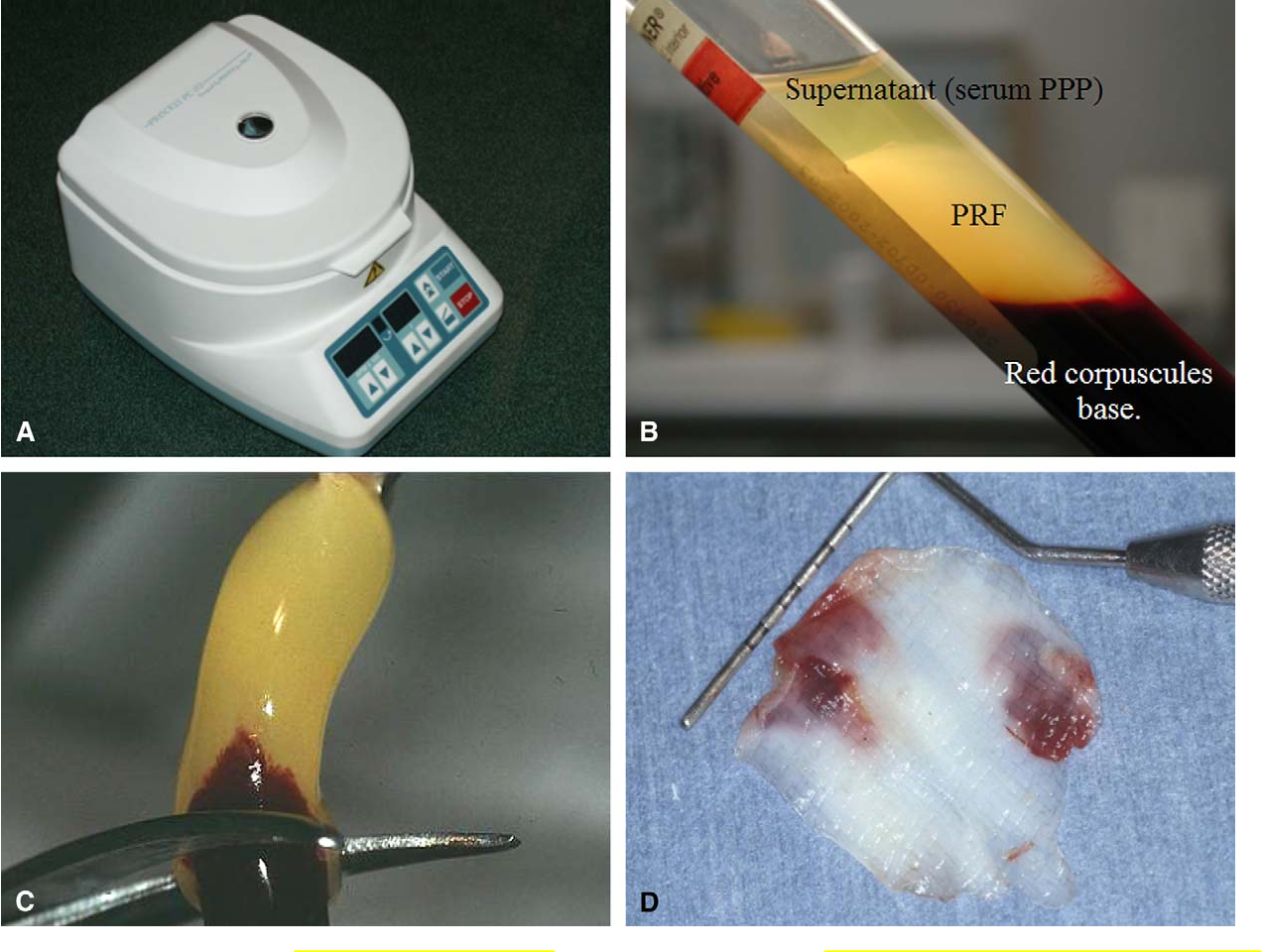 Figure 3 From Platelet Rich Fibrin Prf A Second Generation Platelet