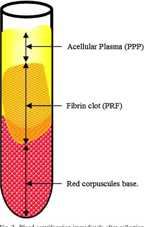 Pdf Platelet Rich Fibrin Prf A Second Generation Platelet