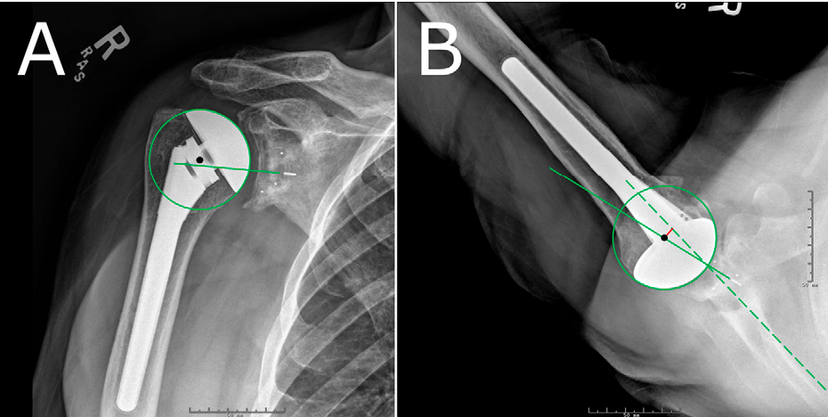 Figure 1 From Clinical And Radiographic Outcomes Of A Posteriorly