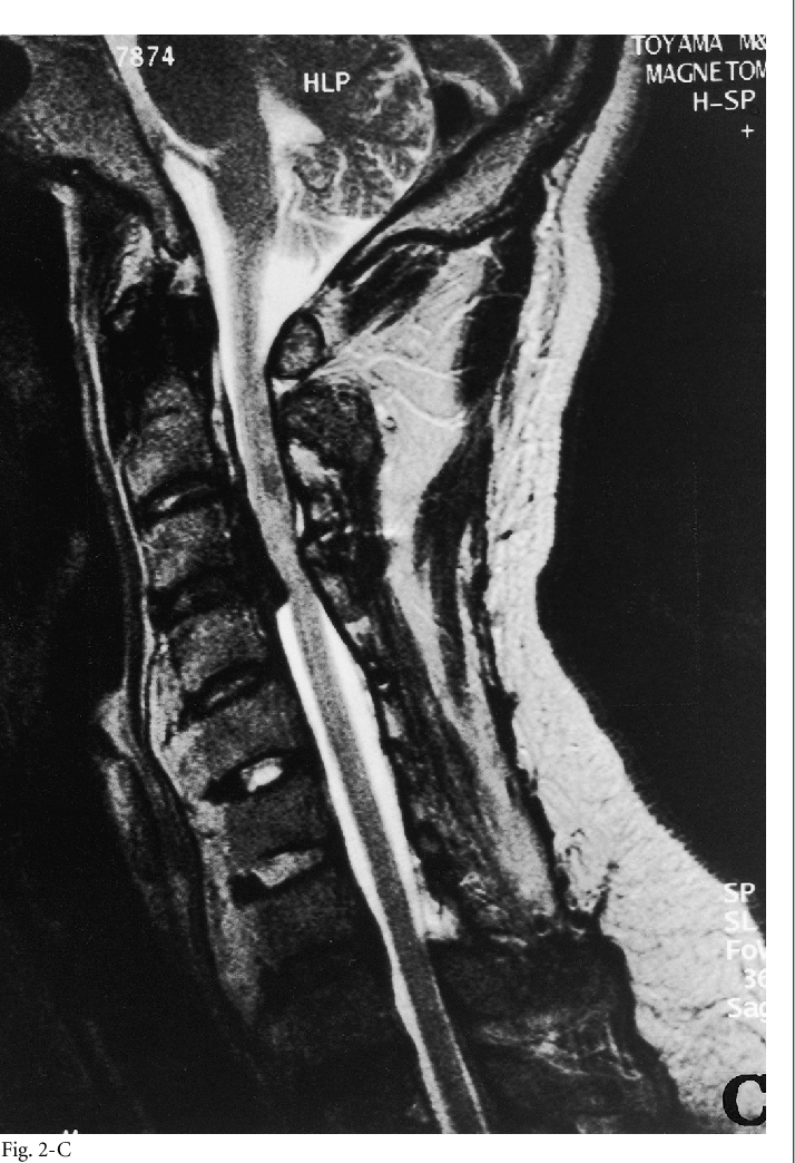 Figure 2 From Progression Of Ossification Of The Posterior Longitudinal