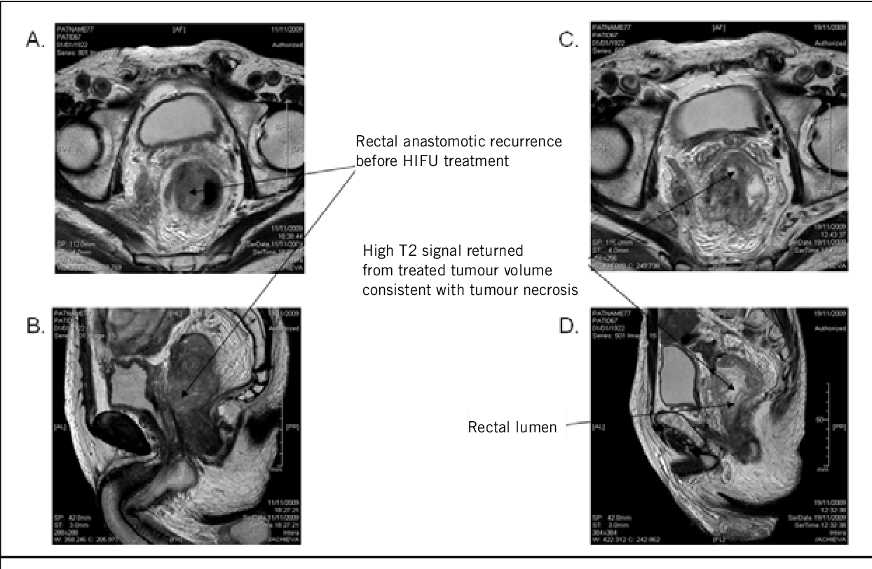 Transrectal High Intensity Focused Ultrasonography Is Feasible As A New