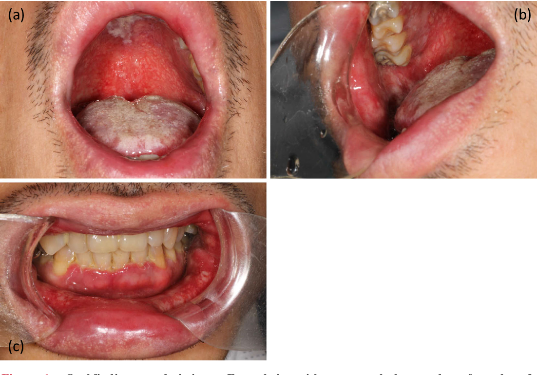 Necrotizing Ulcerative Gingivitis Before And After