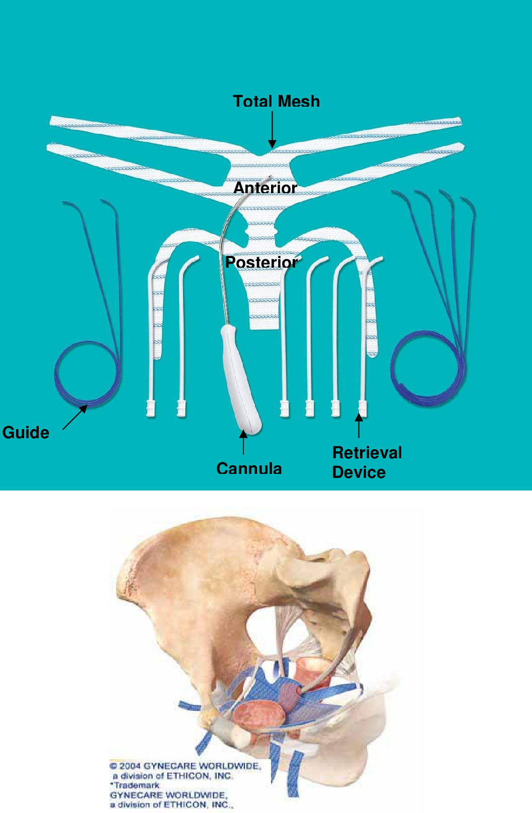 Figure 3 From Vaginal Mesh Kits For Pelvic Organ Prolapse Friend Or
