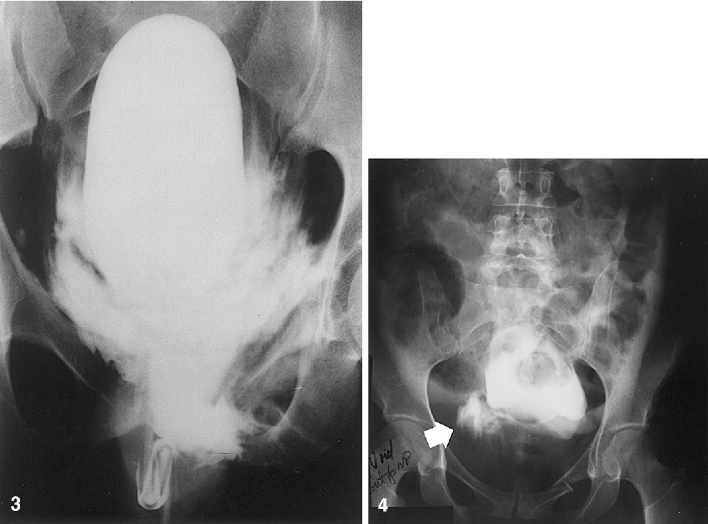 Bladder Rupture From External Trauma Diagnosis And Management