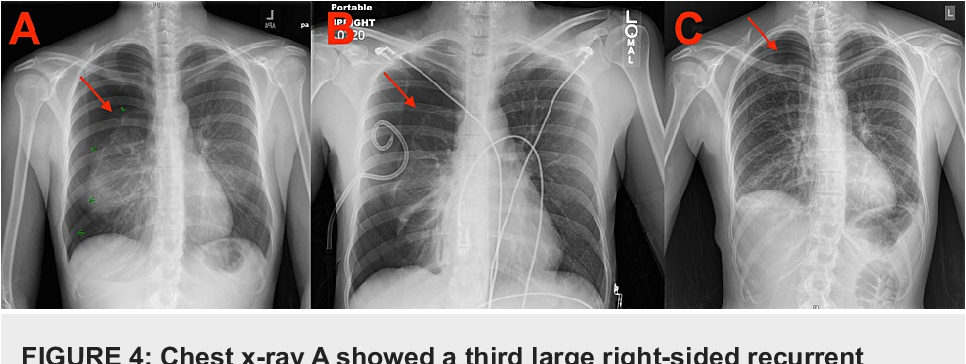 Pdf A Rare Case Of Catamenial Pneumothorax And A Review Of The