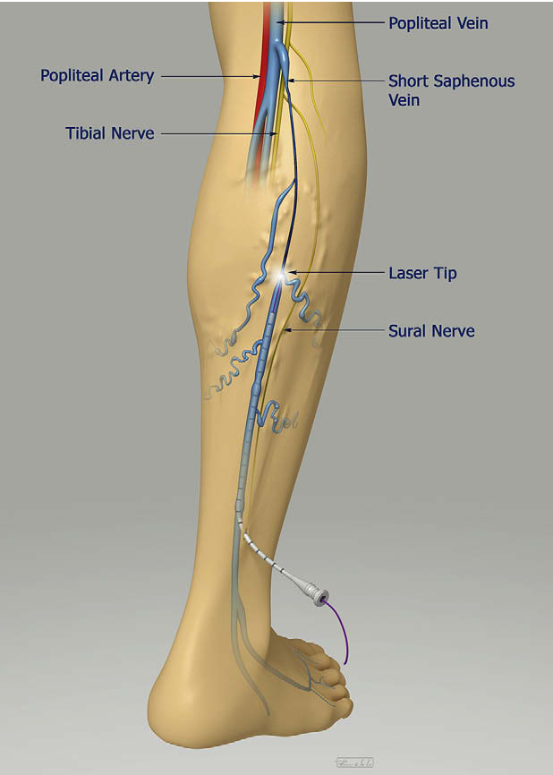 Great Saphenous Vein