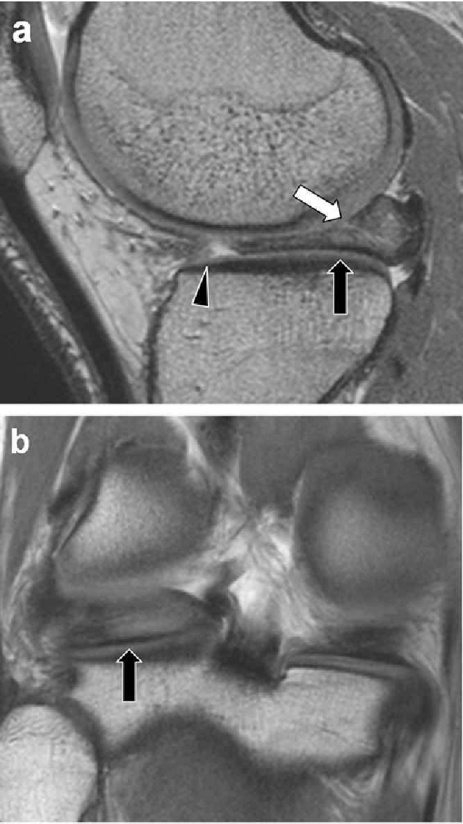 Mri Findings With Arthroscopic Correlation For Tear Of Discoid Lateral