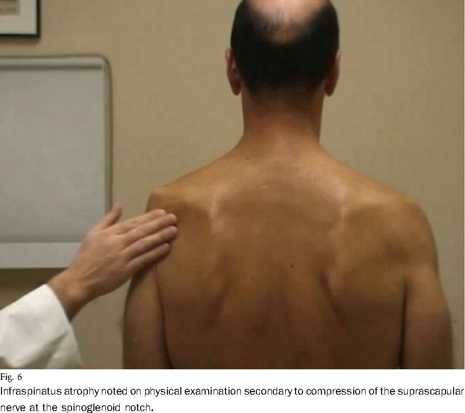 Figure 2 From Suprascapular Neuropathy Semantic Scholar