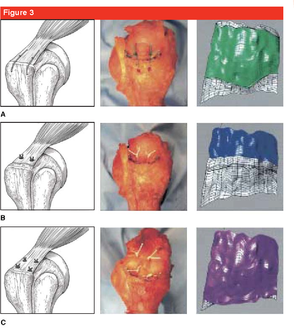 Single Row Versus Double Row Rotator Cuff Repair Techniques And