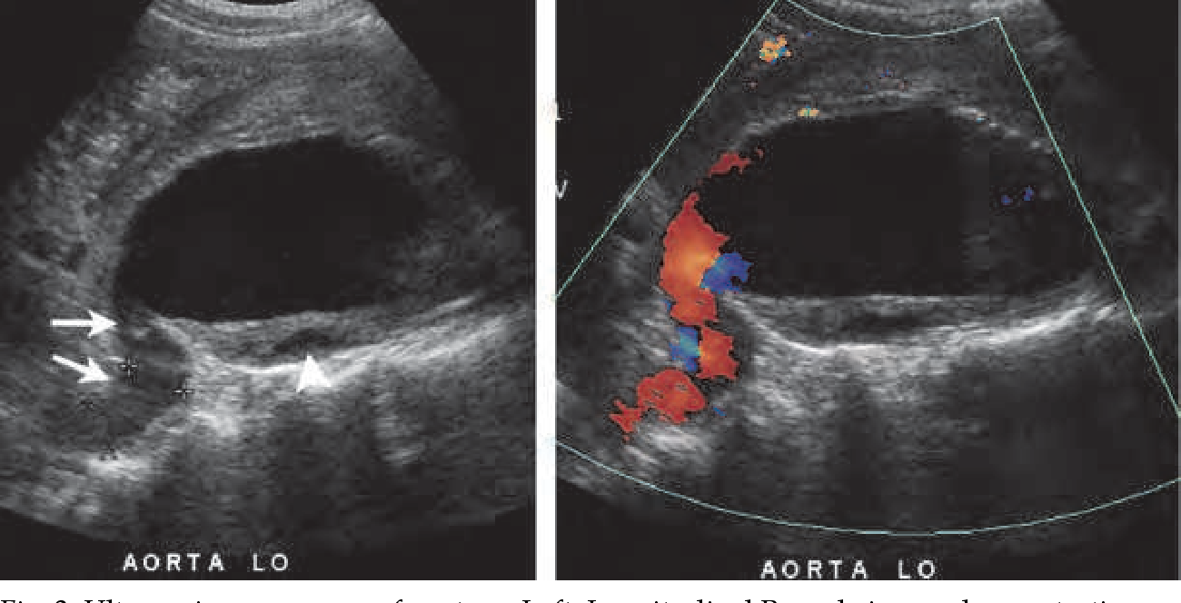 Figure 1 From 7 Ultrasound In Abdominal Aortic Aneurysm Semantic Scholar