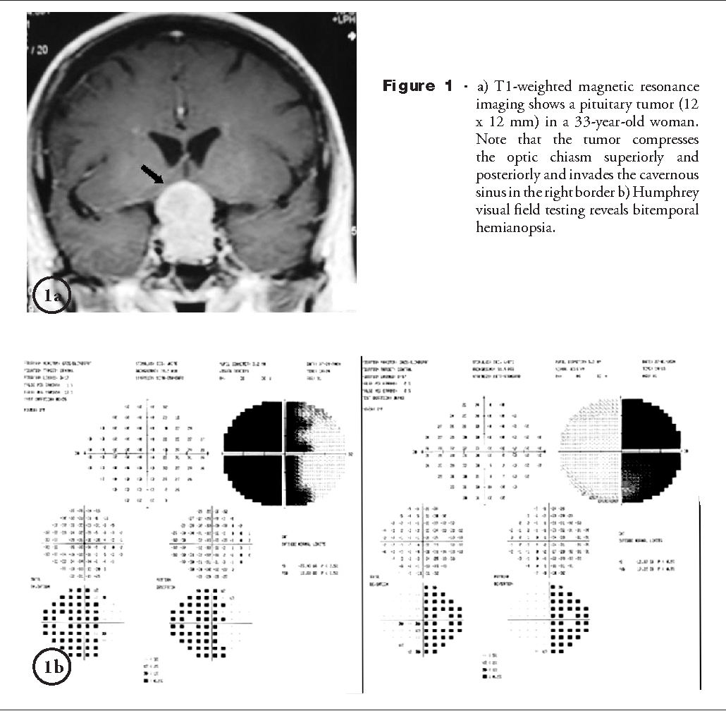 Figure 2 From Humphrey Visual Field Analysis Visual Field Defects And