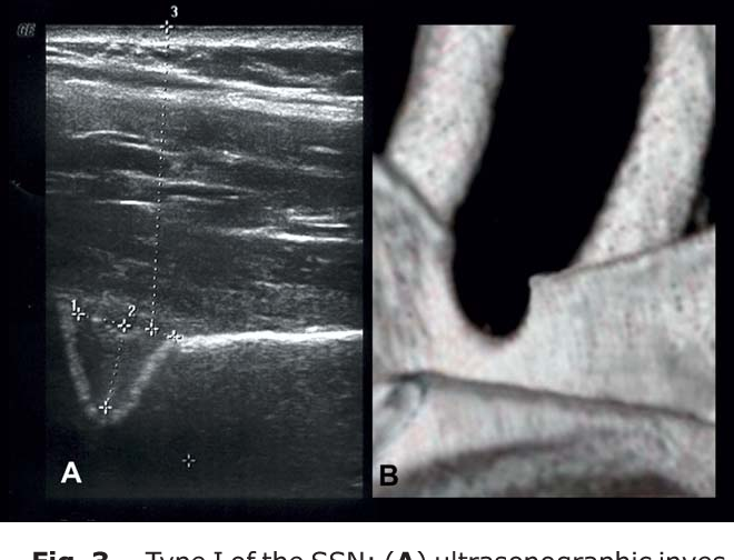 Figure 1 From Clinical Evaluation Of The Shape Of The Suprascapular