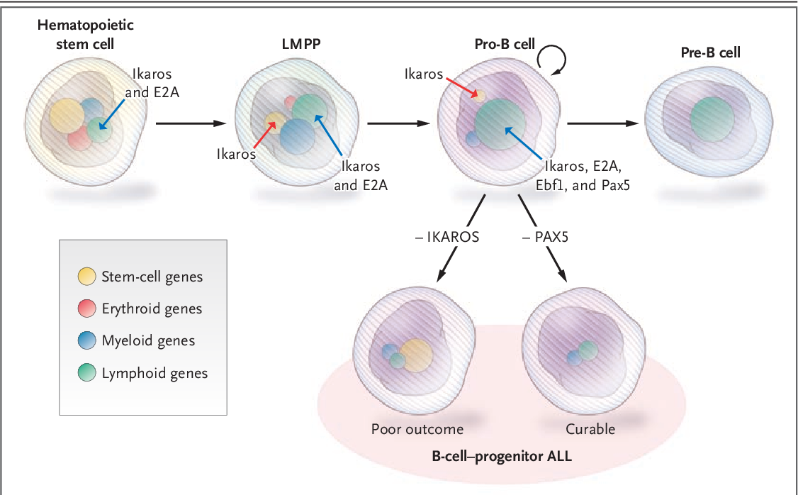 Acute Lymphoblastic Leukemia Diagram