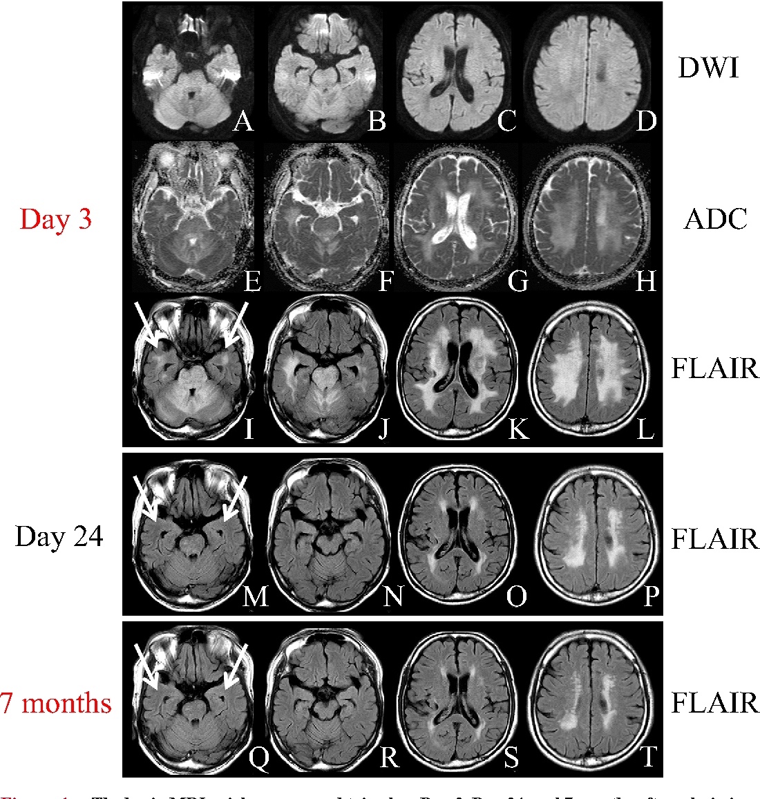 Figure 1 From Posterior Reversible Encephalopathy Syndrome With