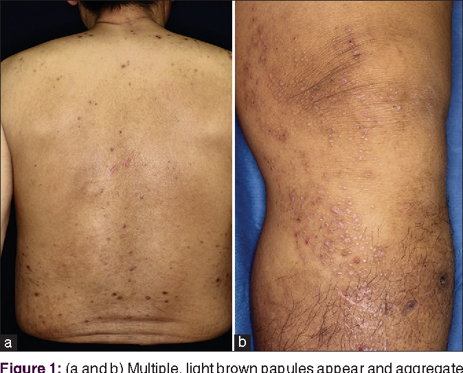 Figure 1 From Lichen Amyloidosis Associated With Chronic Renal Failure